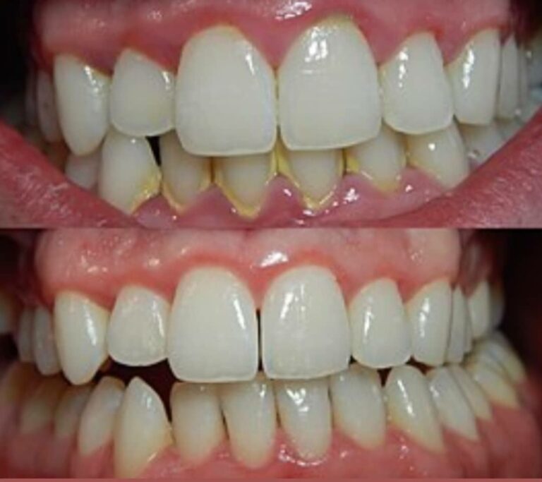 What Is Plaque? The Sticky Truth About Build up on Your Teeth - Church ...